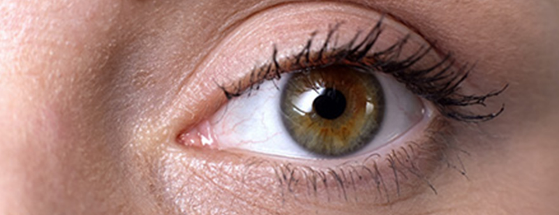 IPL treatment - Optimum Vision Clinic